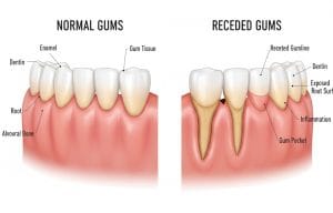 Exposed Tooth Root: Causes, Symptoms, and Treatment Options